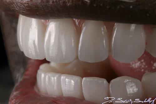 Why Straight Teeth Are Better for Your Health